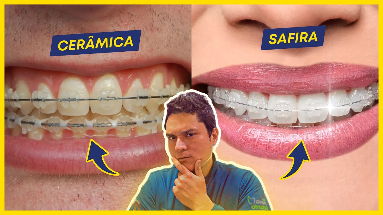 APARELHO DE CERÂMICA X SAFIRA: QUAL O MELHOR? (A VERDADE). - YouTube