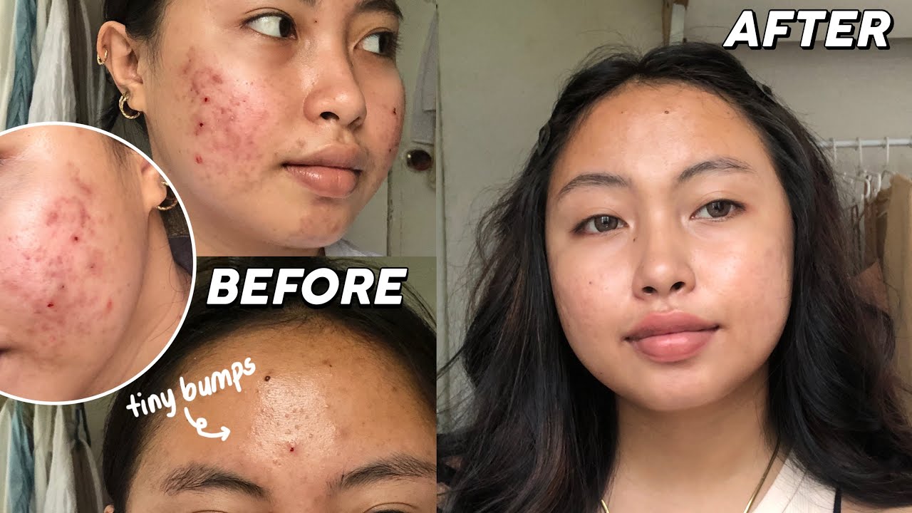 HOW I CURED MY ACNE IN 1 MONTH with pics and vids *not sponsored ...