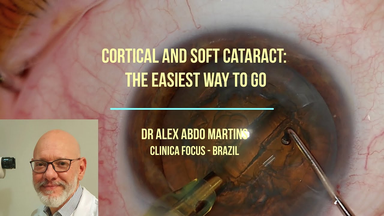 CORTICAL AND SOFT CATARACT: THE EASIEST WAY TO GO - YouTube
