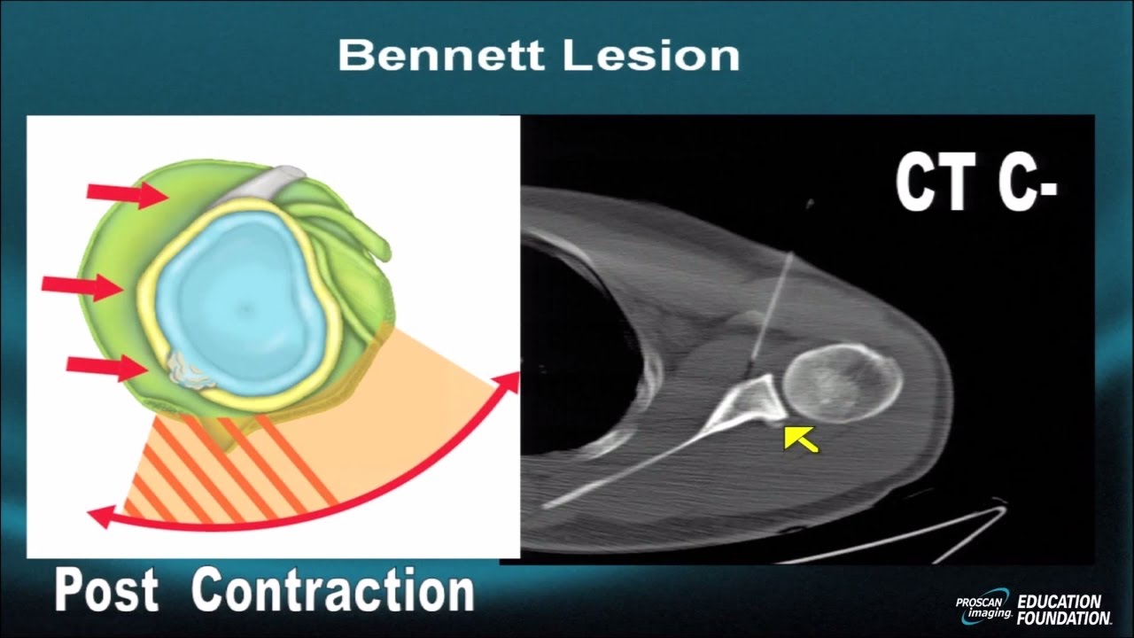 Shoulder InstabilityMRI: Part VII Bennett Lesion POLPSA Capsulolabral ...