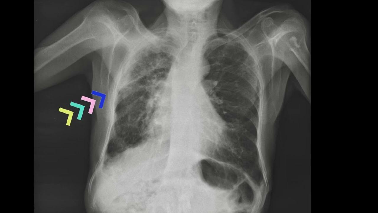 TUBERCULOSIS PULMONAR RADIOGRAFÍA TÉLE DE TÓRAX - YouTube