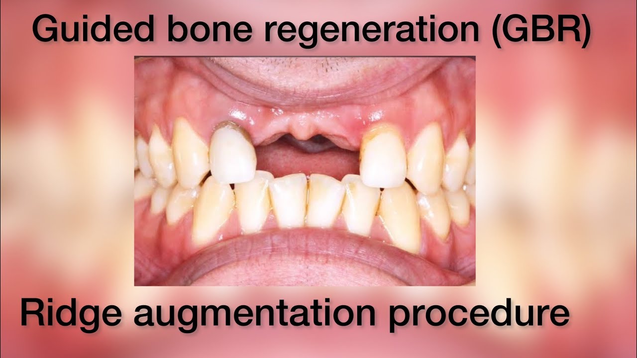 Guided bone regeneration || ridge augmentation with bone graft ...