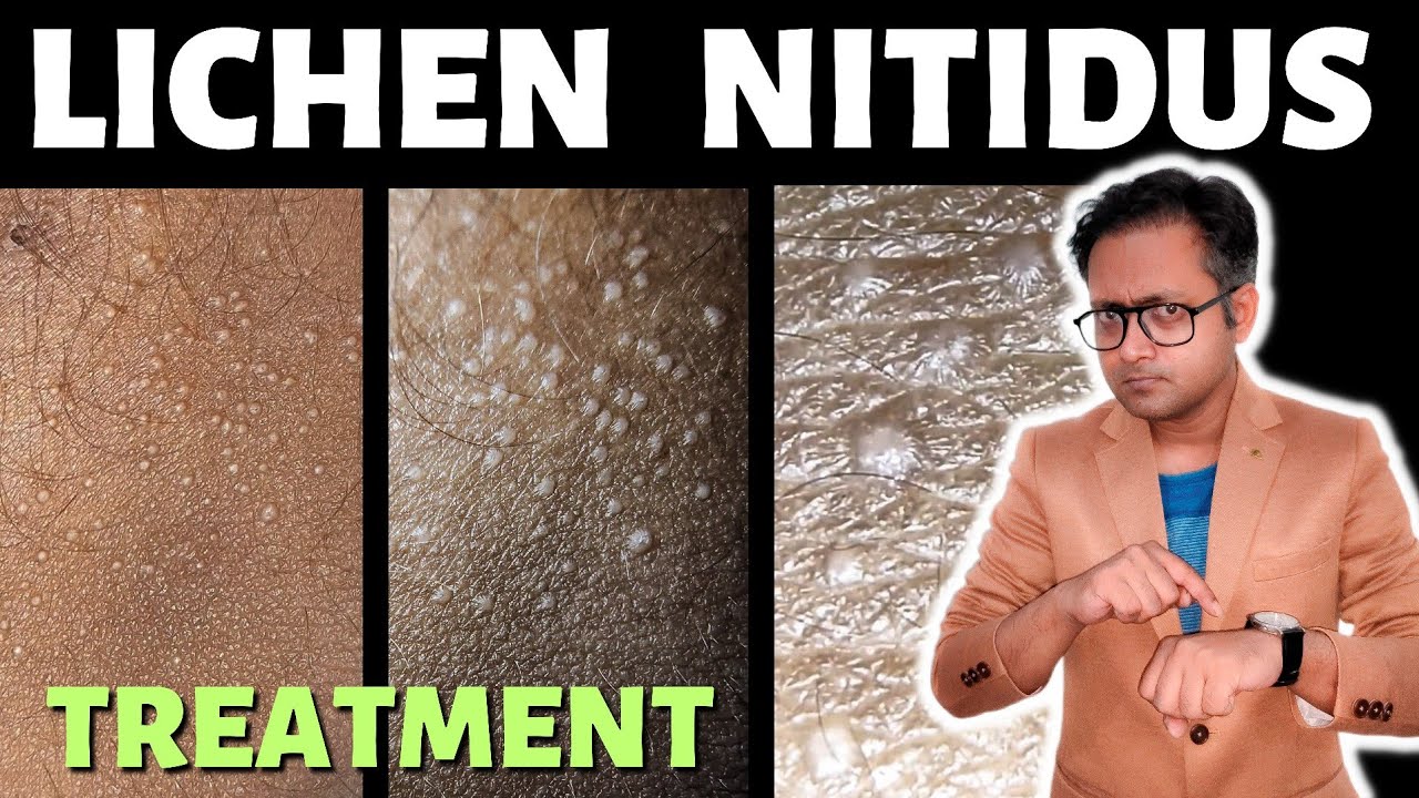 Lichen nitidus | Treatment | Hindi - YouTube
