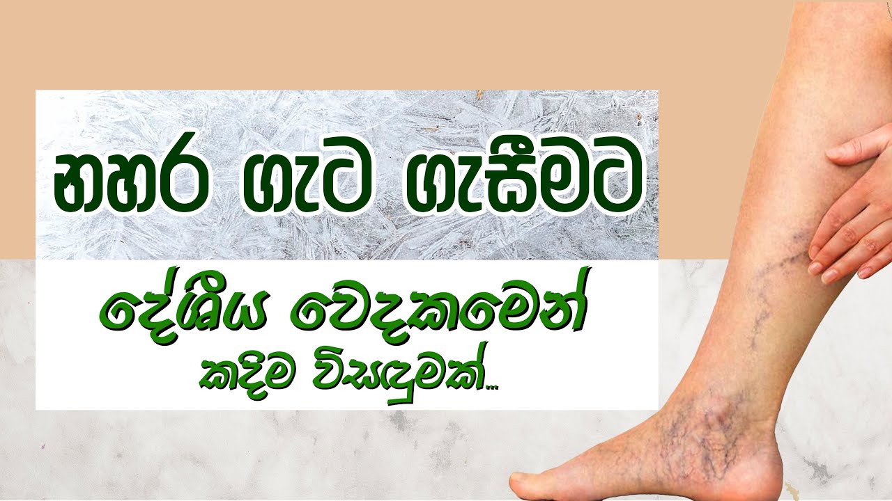 නහර ගැට ගැසීමට දේශීය වෙදකමෙන් කදිම විසඳුමක් | Varicose Veins | Nahara ...