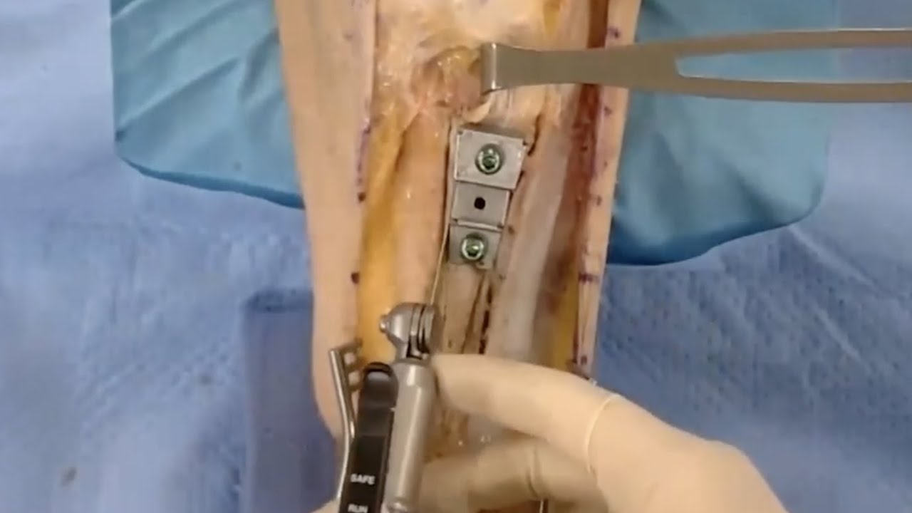 Seth L. Sherman, MD demonstrates a MACI procedure with a TTO using the ...