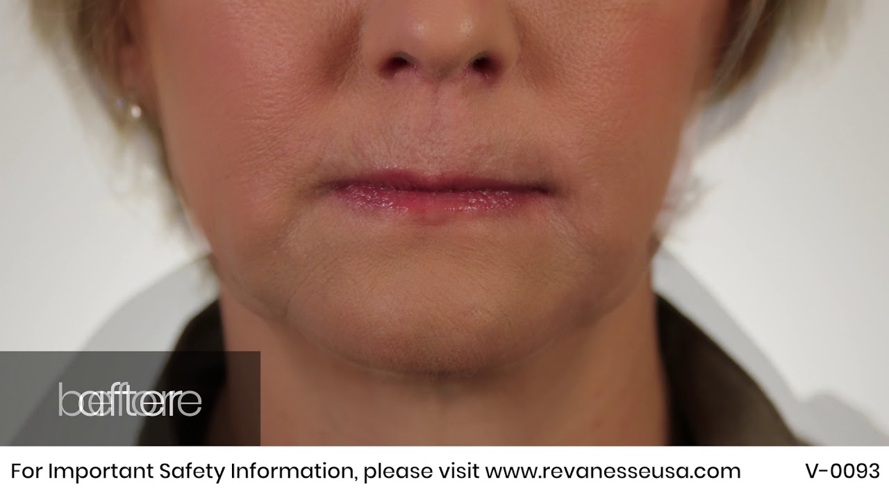 Prollenium Revenesse Versa Before and After - Anne - YouTube