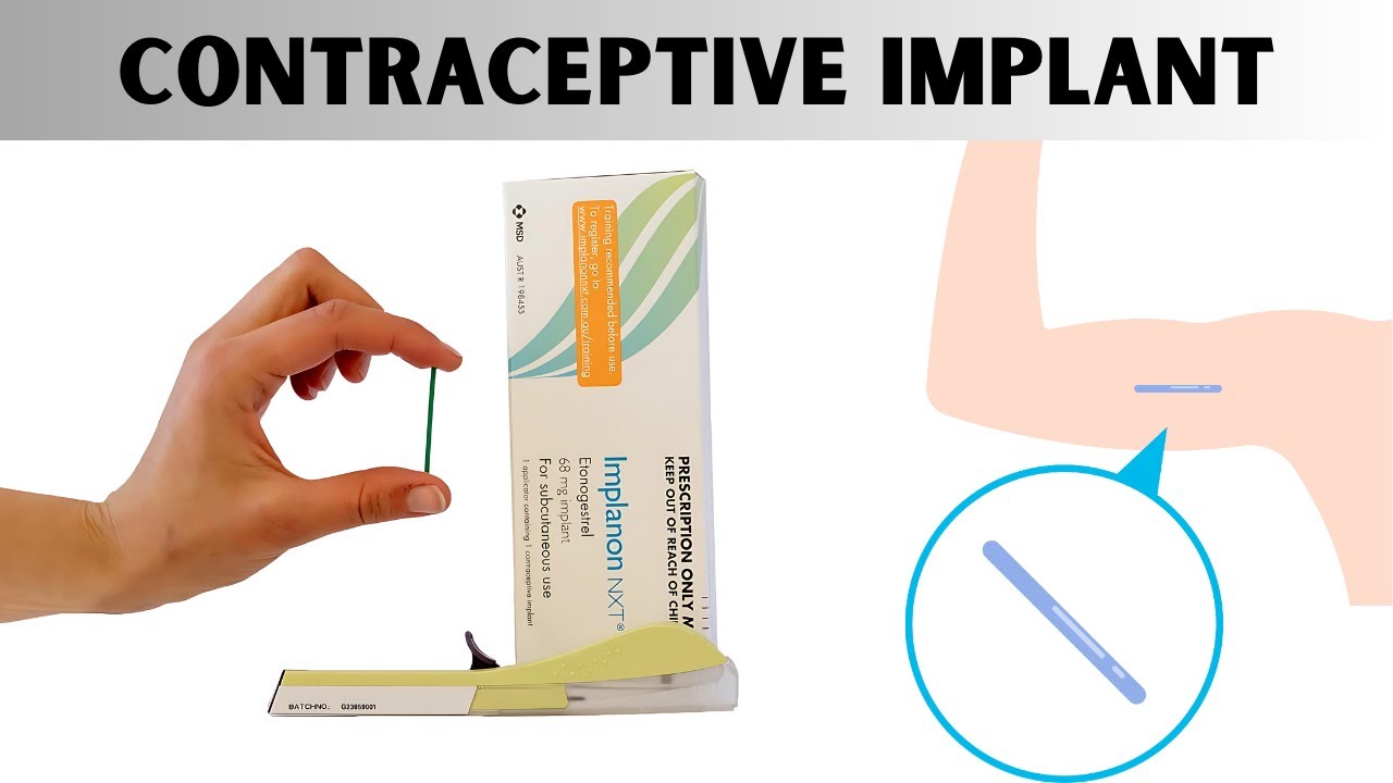 Contraceptive (Progesterone) Implant - Uses, Mechanism Of Action ...