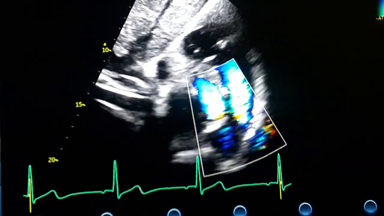 pulmonar view in subcostal window - YouTube