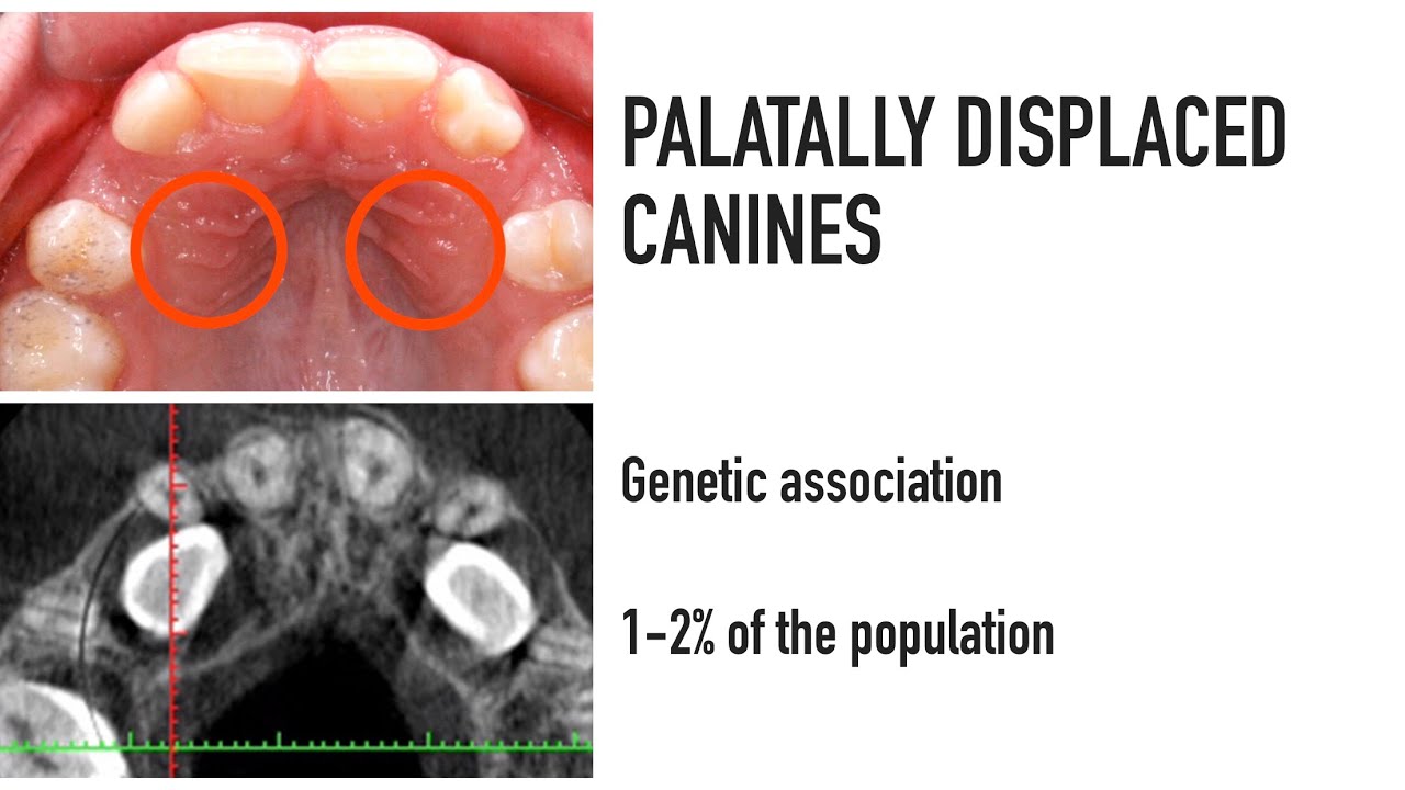Palatally Displaced Canines (PDC), 10 cases - YouTube