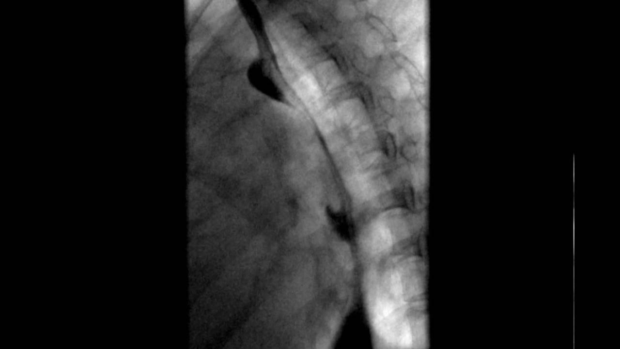 Esophagram Traction Diverticulum - YouTube