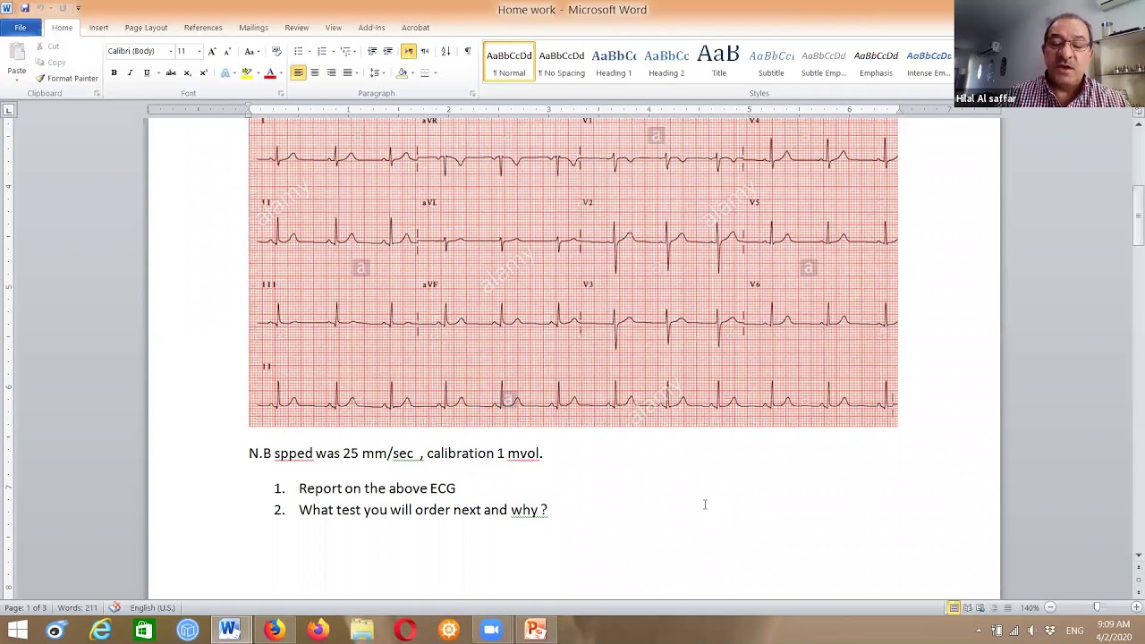 ECG Rhythm disturbance - YouTube