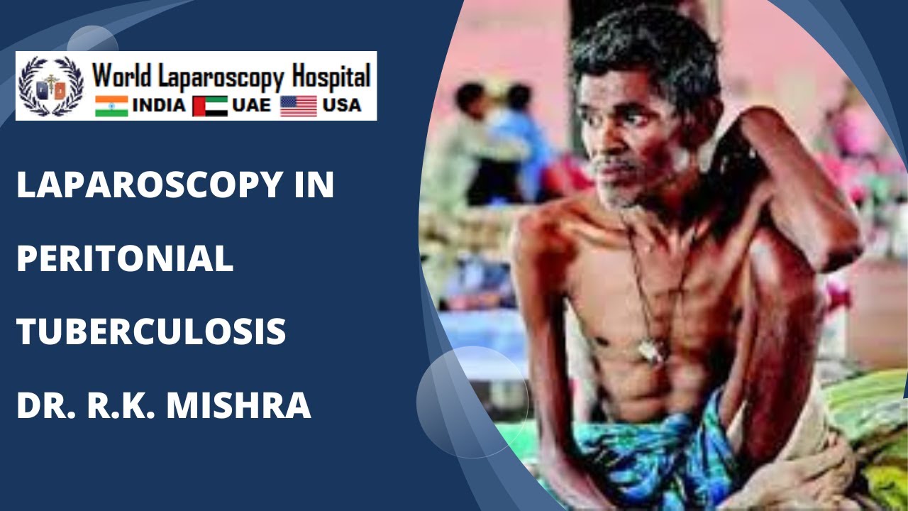 Laparoscopy in Peritoneal Tuberculosis: A Revolutionary Diagnostic and ...