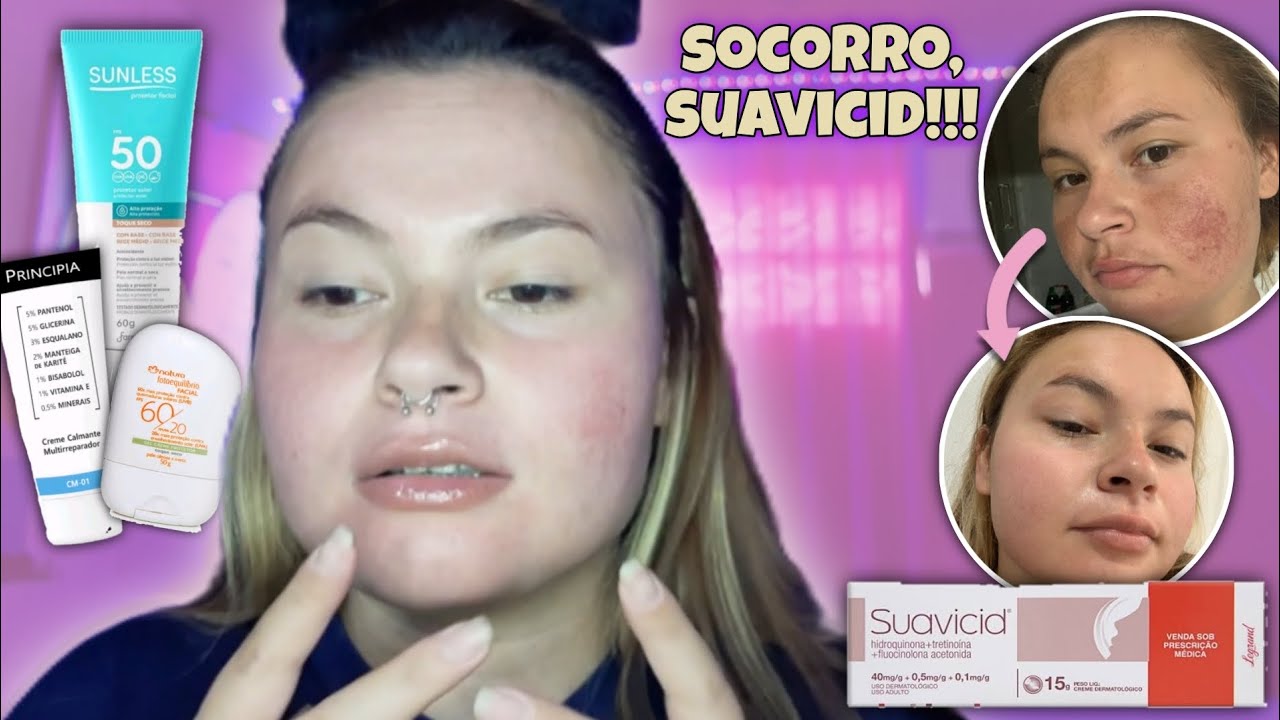 VOLTEI A USAR A POMADA SUAVICID | MELASMA | HIDROQUINONA | Ket Brinhol ...