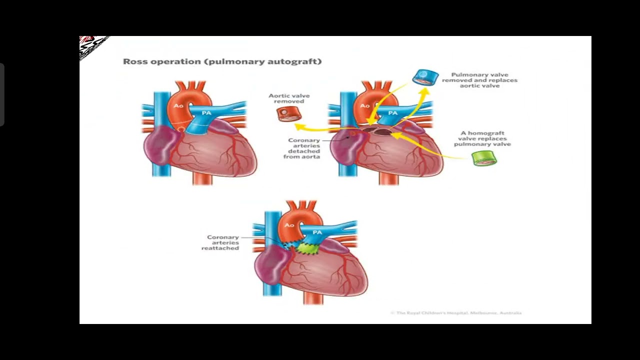 Ross Operation - YouTube