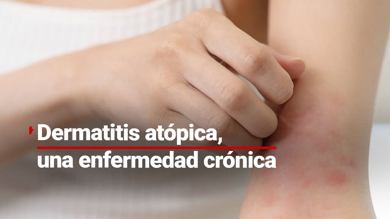 Dermatitis atópica | Enfermedad crónica que causa inflamación y ...