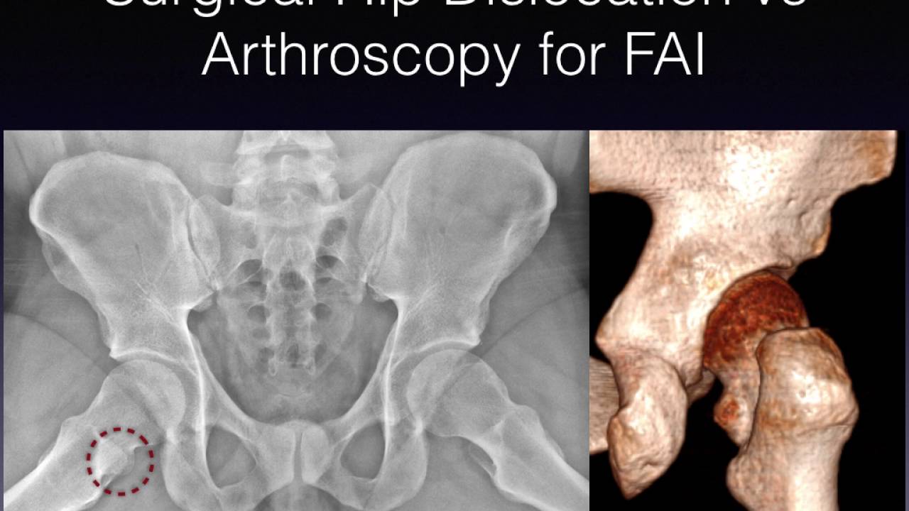 The Evolution of Hip Preservation Surgery | Southern California Hip ...