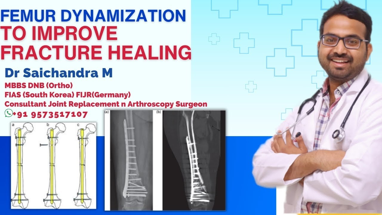 Femur Dynamization – To Improve Fracture Healing | Dr. Sai Chandra MBBS ...