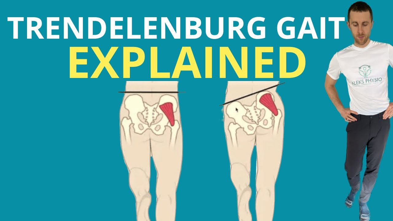 Trendelenburg Gait: Explained - YouTube