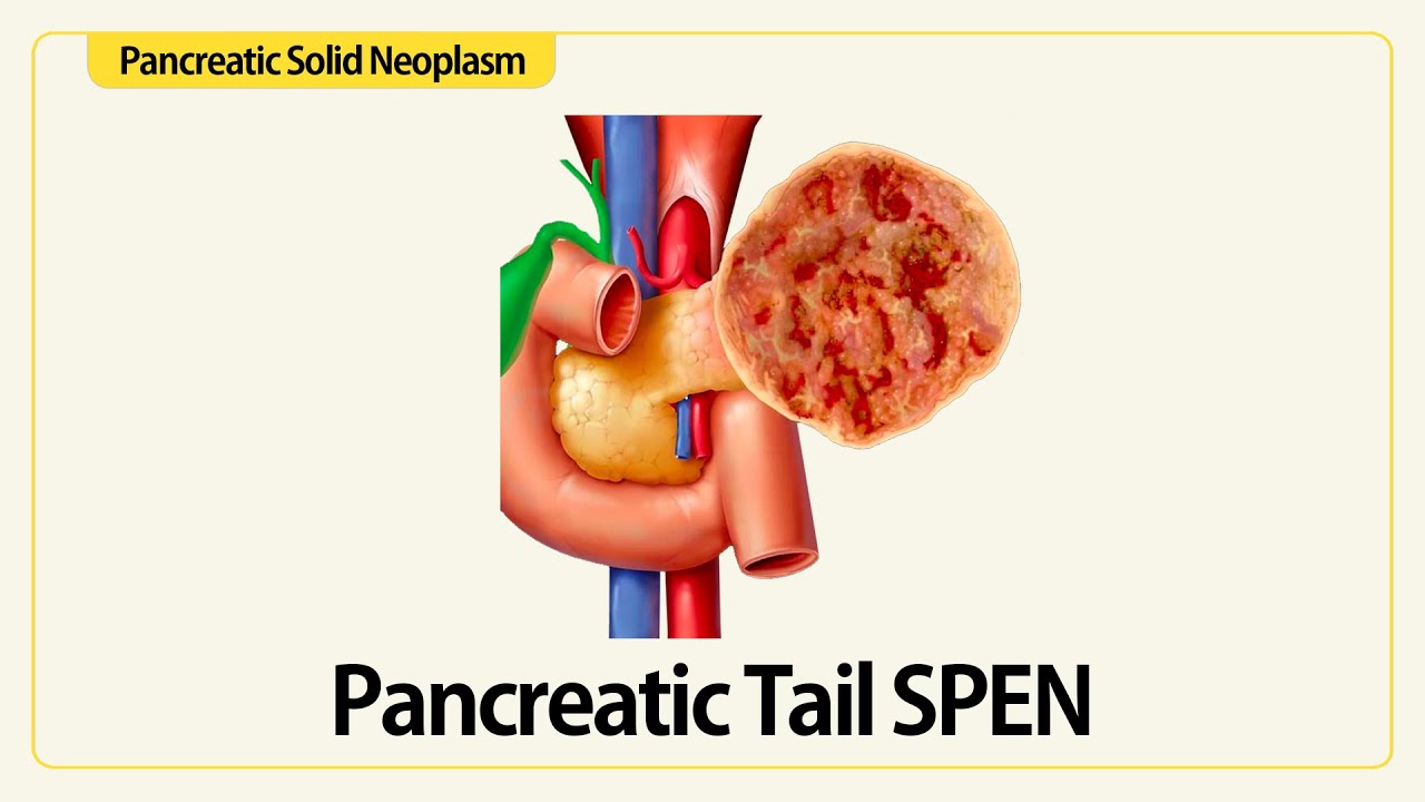 Linear EUS : Pancreatic Tail SPEN - YouTube