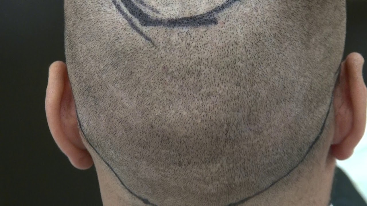 Dr. Diep FUE Scars 12 Months After FUE Hair Transplant Surgery ...