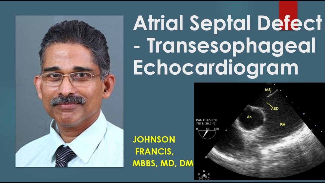 Atrial Septal Defect Transesophageal Echocardiogram Youtube
