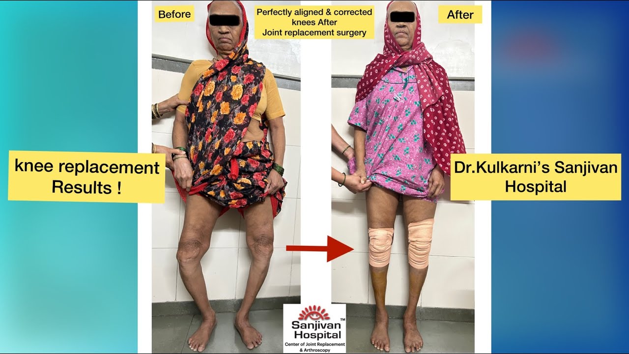 Total Knee Replacement Surgery - A Life Changing experience | Sanjivan ...
