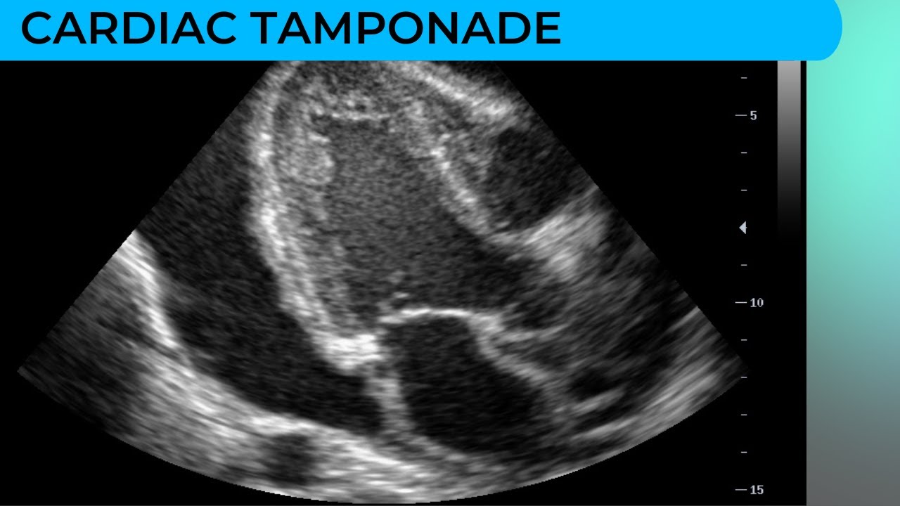 Pericardial tamponade (Troubled heart) on ultrasound scan - YouTube