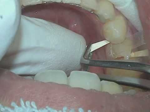 Class II Restoration ( resin composite ) - YouTube