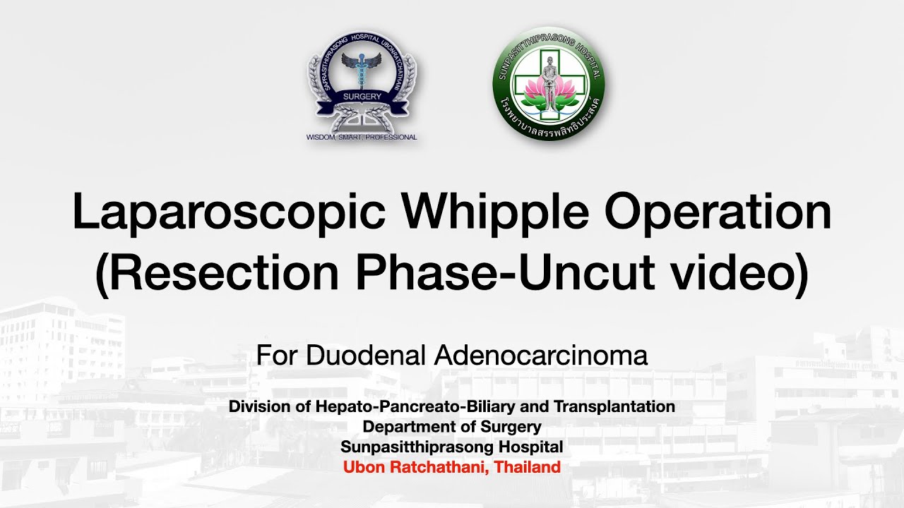 Laparoscopic Whipple Operation (Lap Pancreaticoduodenectomy); Resection ...