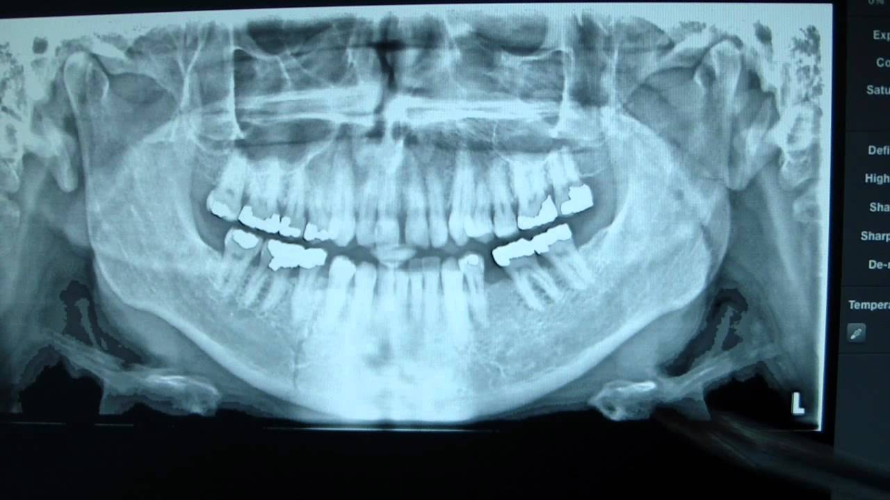 Mandibular Fracture X Ray