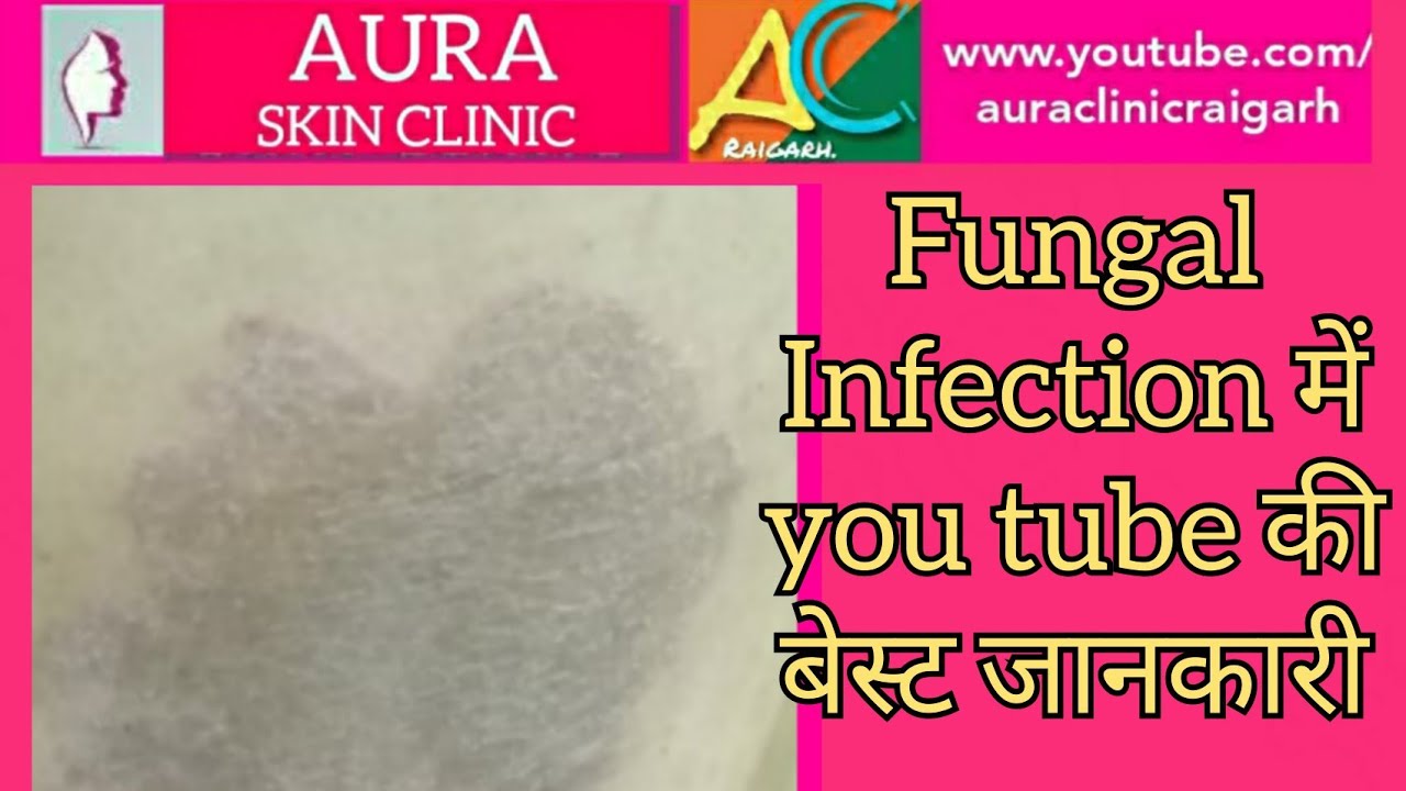 Fungal Infection के बारे में You Tube की Best Information - YouTube