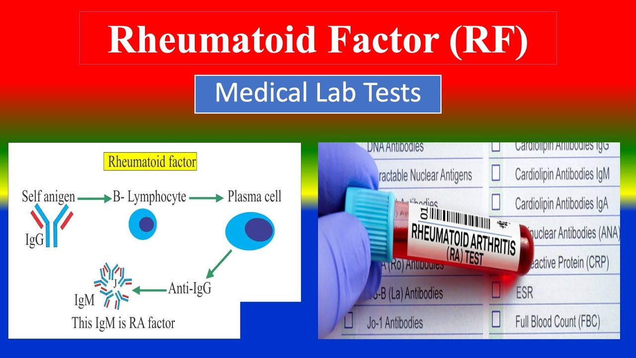 Rheumatoid Factor (RF) Test - Medical Lab Tests - What is ? , Uses ...