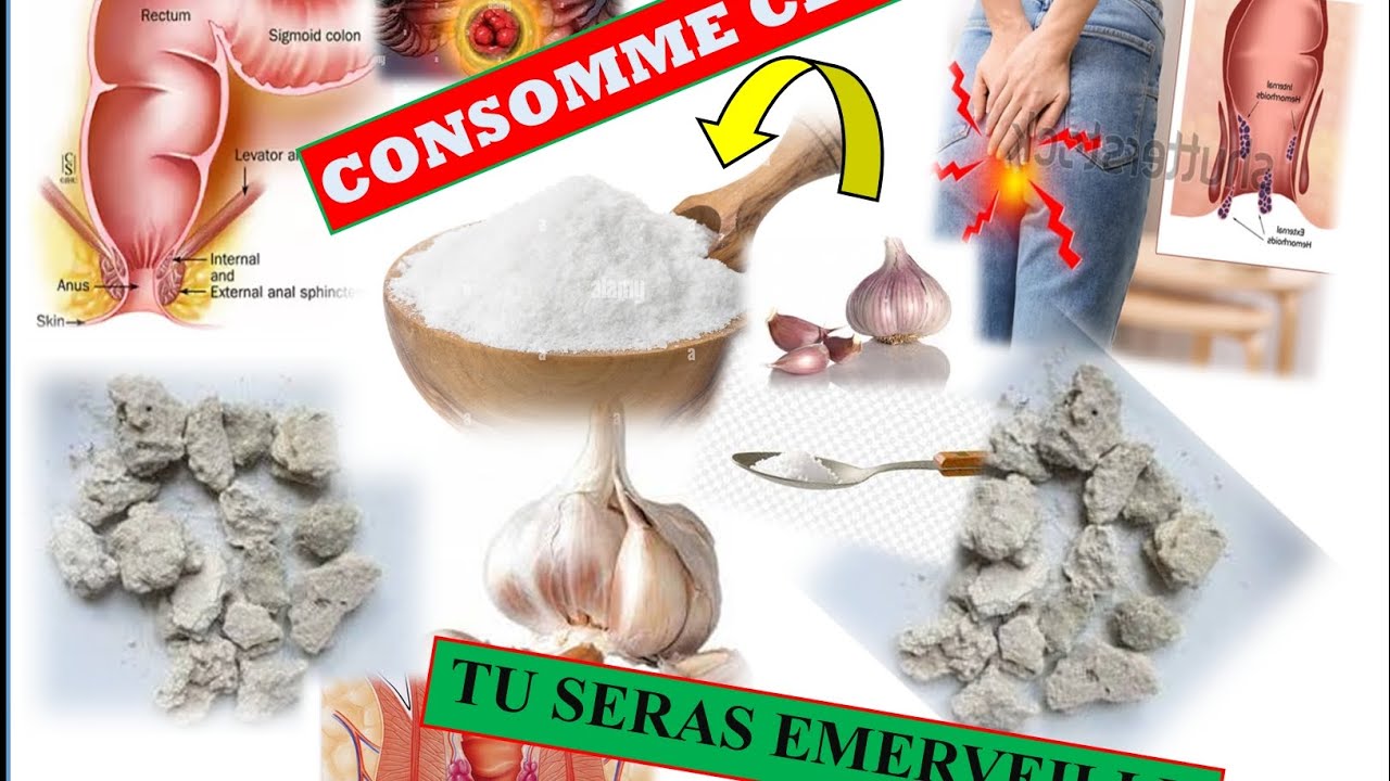 DITES AU-REVOIR AUX HÉMORROÏDES EXTERNES ET INTERNES EN PRENANT CECI ...