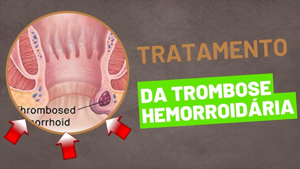 Tratamento da TROMBOSE HEMORROIDÁRIA! - YouTube