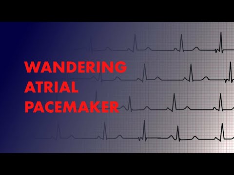 Wandering Pacemaker Rhythm - YouTube