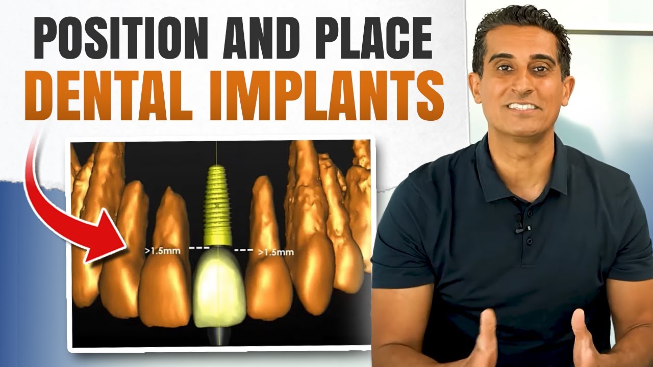How To Position and Place Dental Implants(Rules and Guidelines) - YouTube