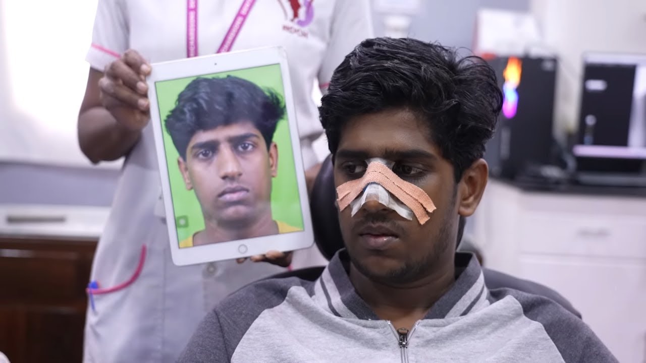 Revealing his Enhanced Nose | The Moment After Rhinoplasty Splint ...