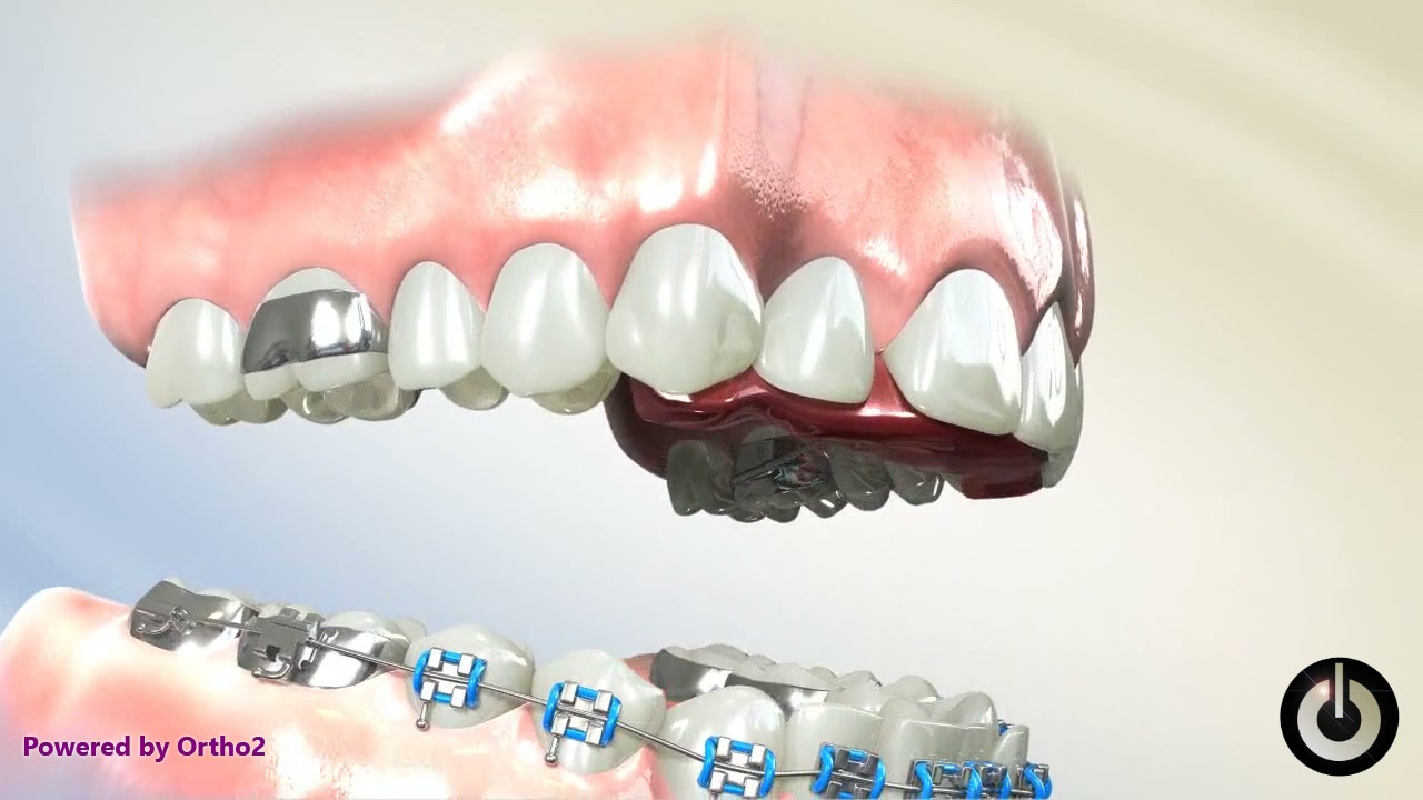 Fixed Bite Plate for Breakage - YouTube