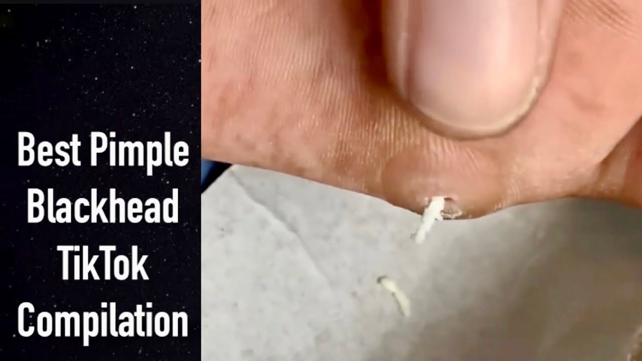 Popping Huge Blackheads and Pimple Popping - Best Pimple Popping videos ...