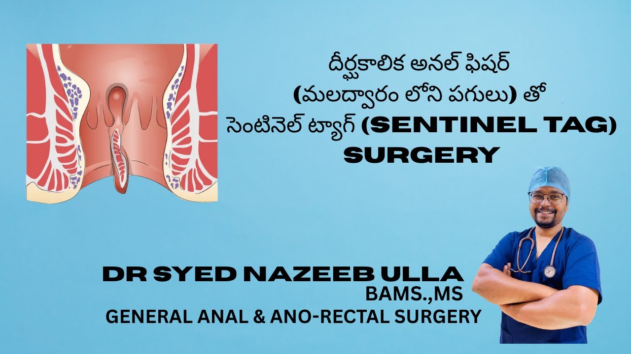 Excision of Sentinel Pile Mass | Chronic Fissure-in-Ano Surgery | Dr ...