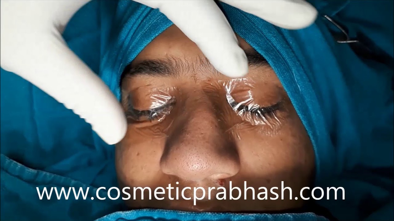 Big Deviated Septum Nose Bone Rhinoplasty Before After India, Delhi ...