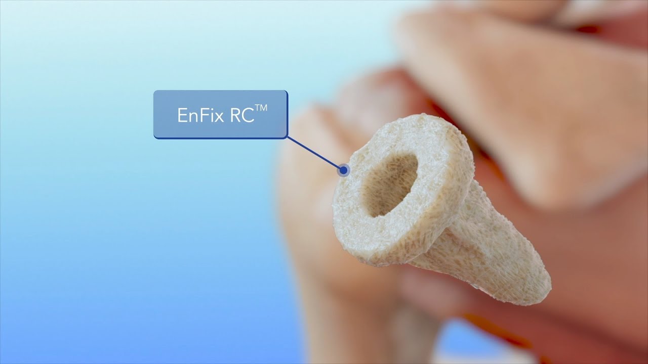 With EnFix RC™ - It's All About the Enthesis™ - YouTube