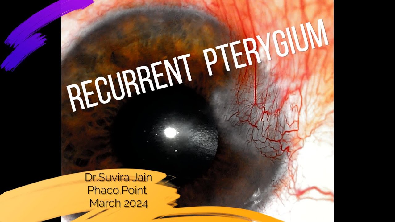 Recurrent Pterygium - Principles of Surgical Management - YouTube