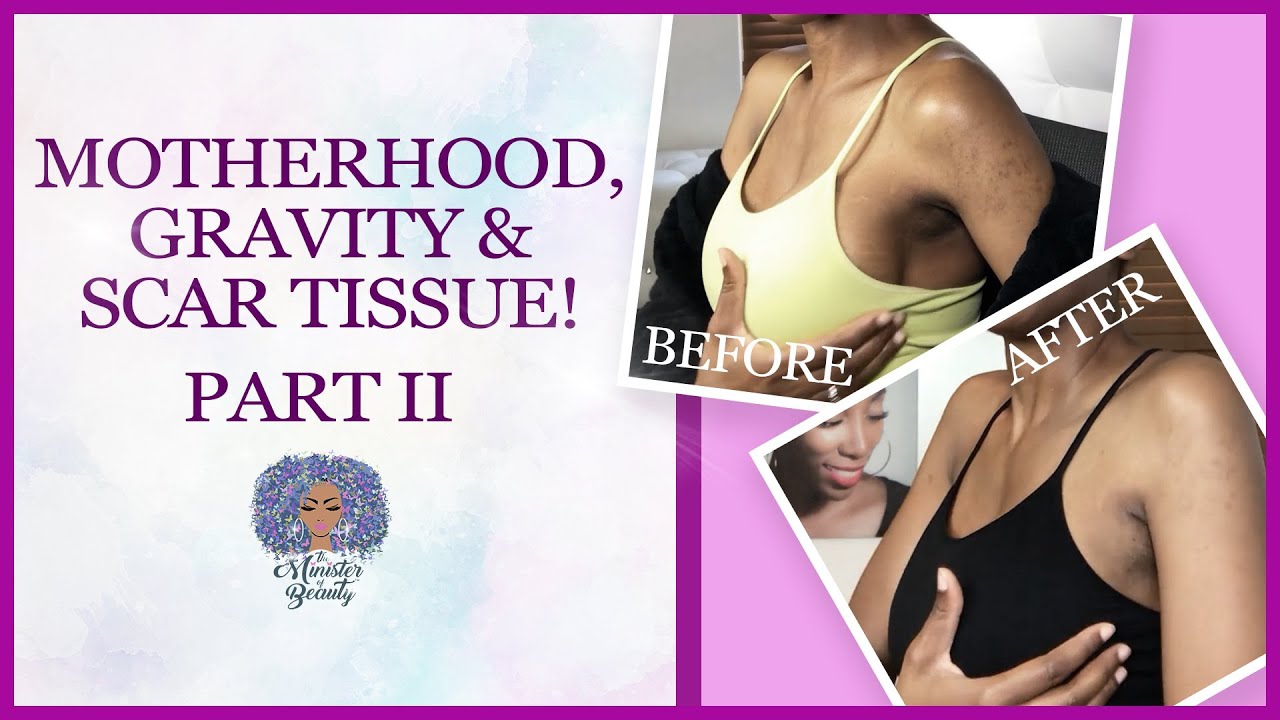 Breast Lift Augment And Implant Illness My Issues And Capsular