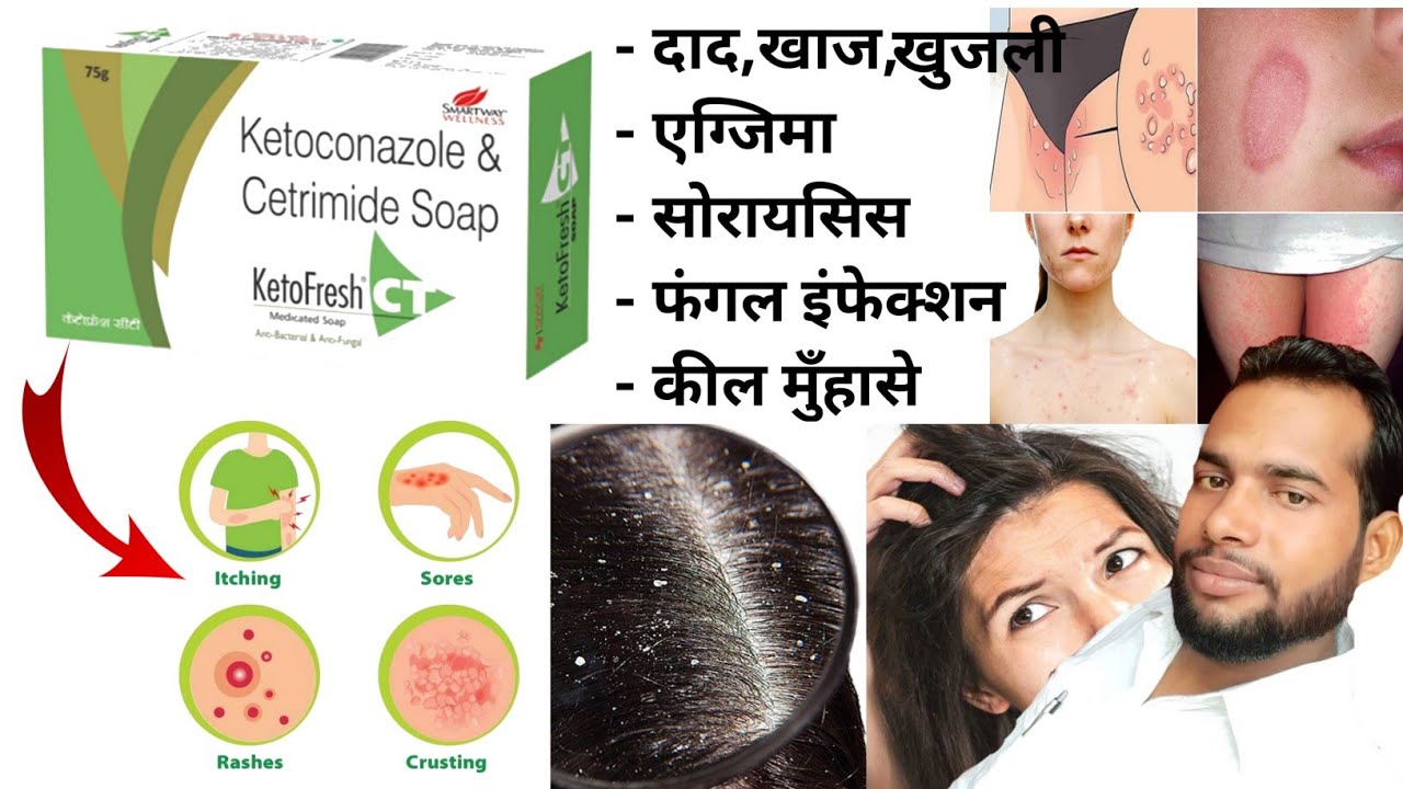 Ketofresh ct soap || दाद खाज खुजली के लिए बेस्ट क्रीम || ketoconazole ...