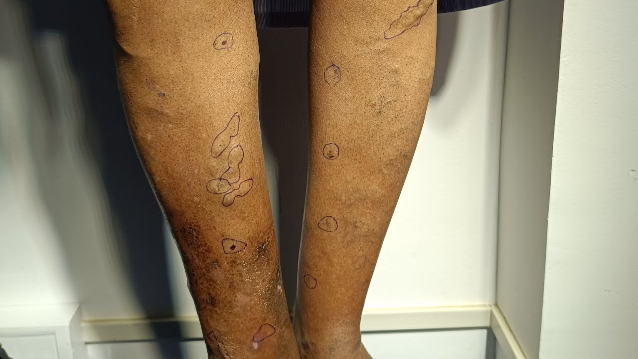 varicose vein surgery. subfascial ligation of perforators and ...