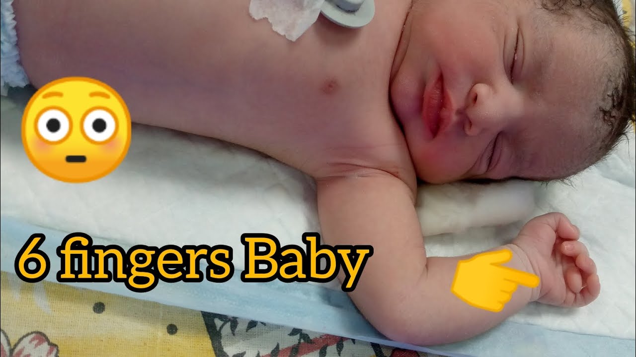 6 Fingers Baby Hand😳 So cute 🥰 baby NICU #newborn #youtubevideos # ...