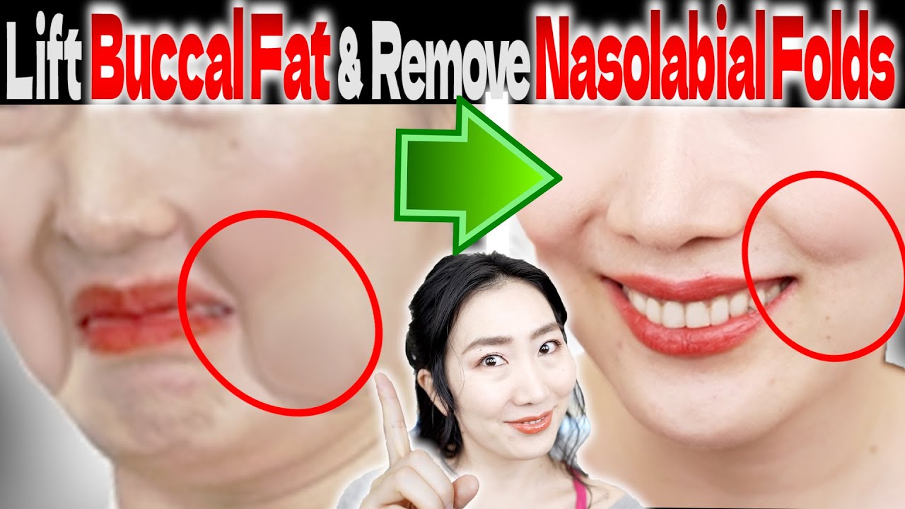 Lifting Buccal Fat is the Key to Remove Nasolabial Folds/ Lifting up ...