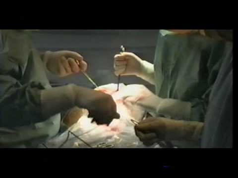 Live c-section done by Dr Boris Petrikovsky - YouTube