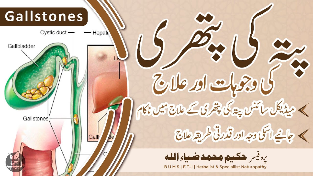 Pitta ki pathri ki waja or ilaj - پتہ کی پتھری کی وجوہات اور علاج - IBN ...